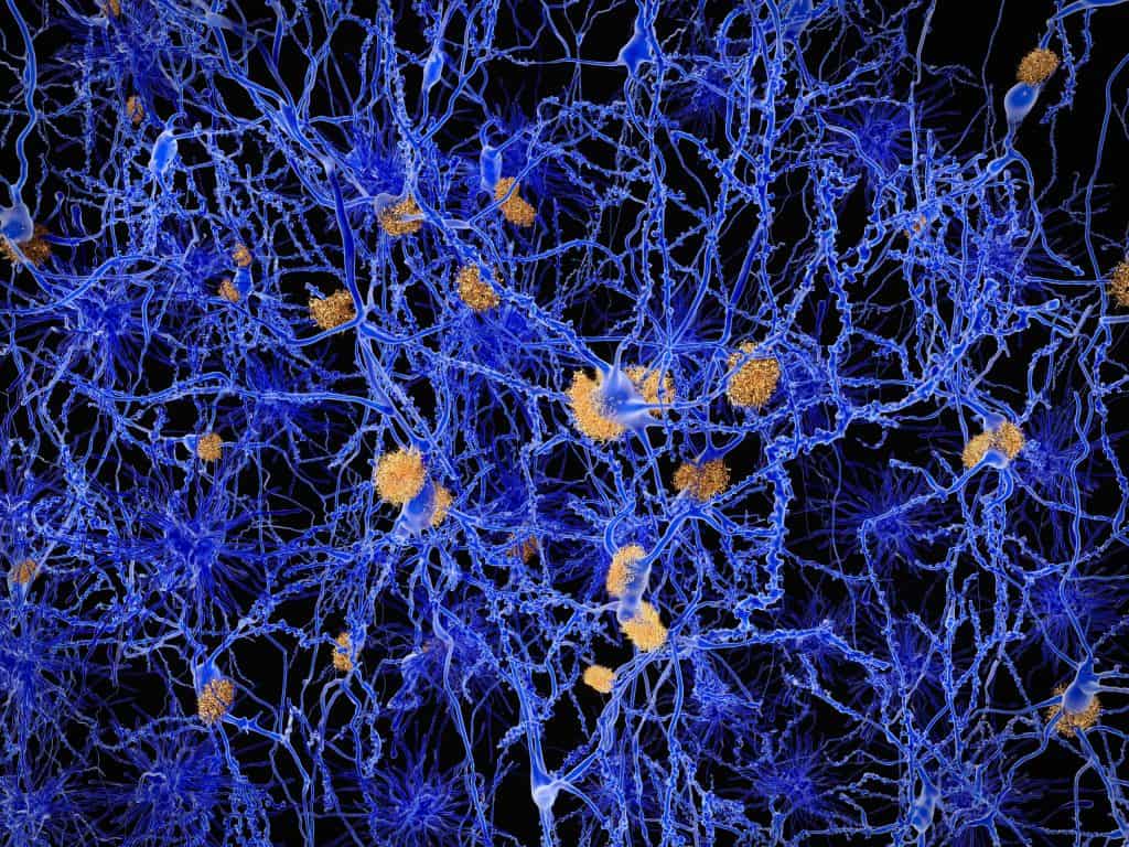 The Neuropathological Hallmarks of Alzheimer’s Disease - Altoida